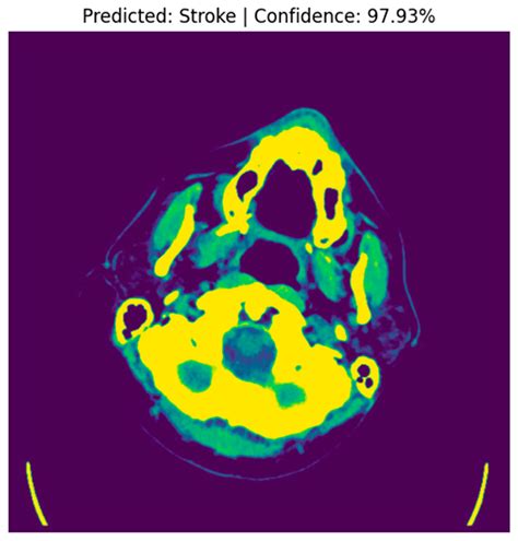 Stroke Detection In Brain Ct Images Using Convolutional Neural Networks Model Development