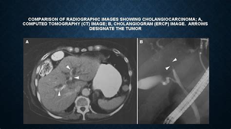 Endoscopic Retrograde Cholangiopancreatography Ercp Introduction