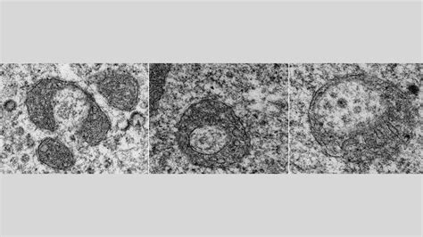 Mitochondria That Self Destruct In A Weird Way May Play A Role In Als