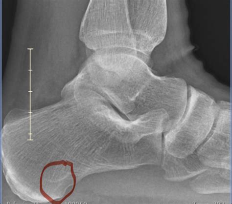 Do I Have A Calcaneal Stress Fracture X Ray Included Rdiagnoseme