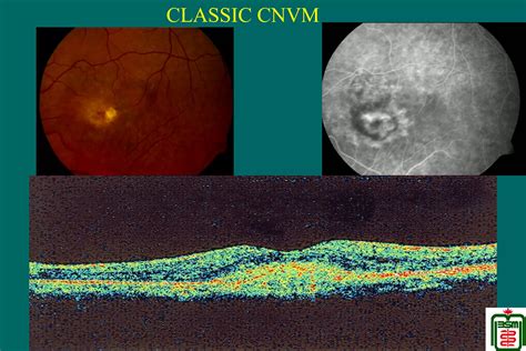 Optical Coherence Tomography Oct Ppt