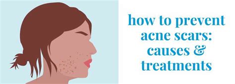 How To Prevent Acne Scars Causes Treatments Pandia Health