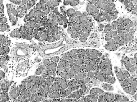 Mononuclear Cell Infiltration And Polymorphonuclear Leukocyte