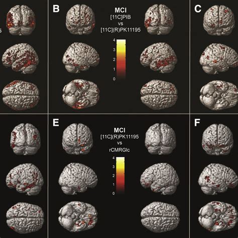 Biological Parametric Mapping Bpm Correlation Between Levels Of Download Scientific Diagram