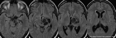 Dr Balaji Anvekar Frcr Giant Tumefactive Perivascular Spaces Mri