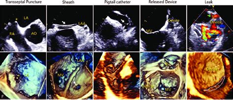 Laa Closure Procedures Under The Guidance Of 2d Tee And Rt 3d Tee Download Scientific Diagram