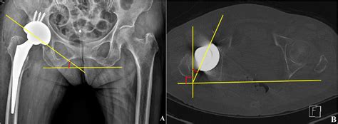 Figure 1 From The Validation Of Two Dimensional And Three Dimensional Radiographic Measurements