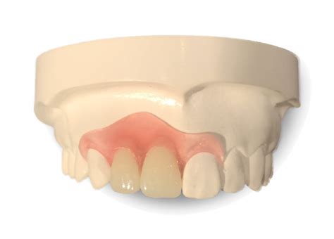 Nesbit Partial Denture Direct Dental Prosthetics