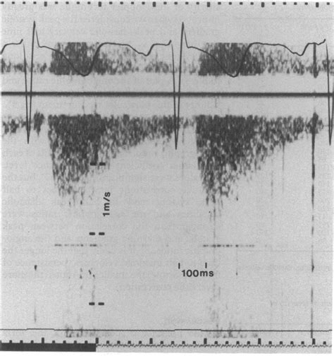 Continuous Wave Doppler Echocardiogram Recorded In A Patient With Se Download Scientific