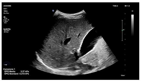 Liver Fibrosis Ultrasound