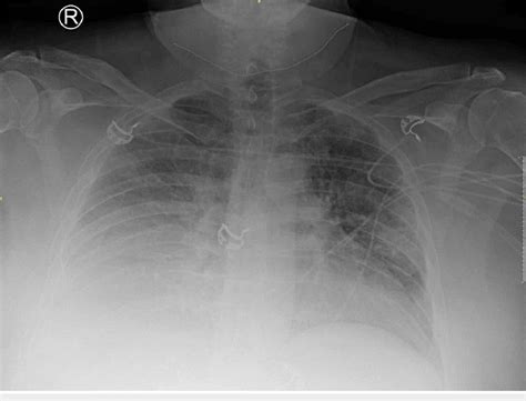 Chest X Ray On Presentation Anterior Posterior Ap View Showing Download Scientific Diagram