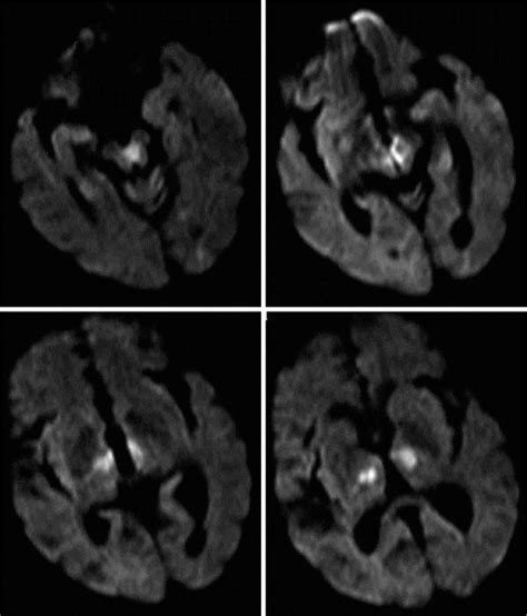 Convulsive Movements In Bilateral Paramedian Thalamic And Midbrain