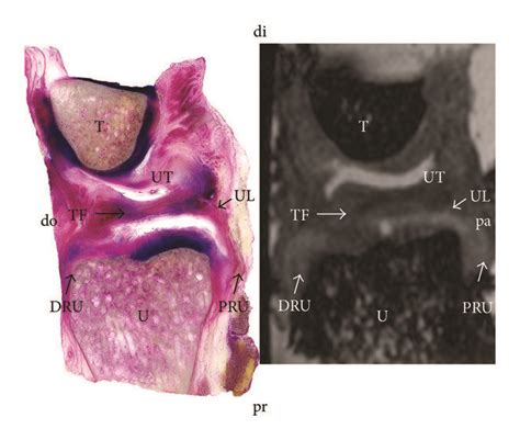 Plastination Of The Triangular Fibrocartilage Disc Complex Sagittal