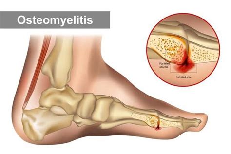 Osteomyelitis The Inflammation Of The Bone Ugwu Ifeyinwa Immaculata Posted On The Topic