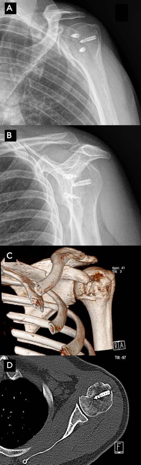 Modified Mclaughlin Procedure Using A Double Row Suture Anchor For Chronic Locked Posterior