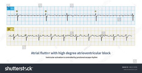 During Atrial Flutter Ventricular Rate Slow 库存插图 1882310998 Shutterstock