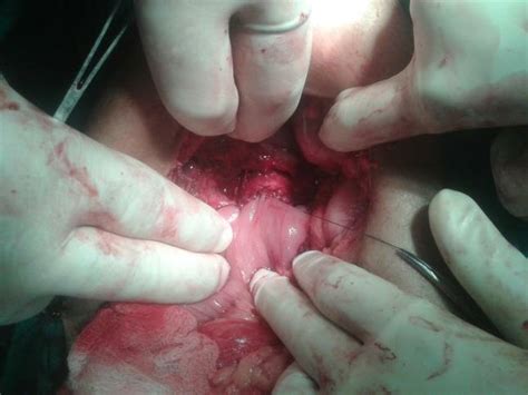 Hepaticojejunostomy Completed After Complete Cyst Excision Download Scientific Diagram