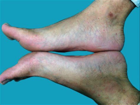 Eruptive Pseudoangiomatosis Cherry Angiomas With Perilesional Halo