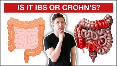 Do You Have IBS Or Crohn S Disease YouTube