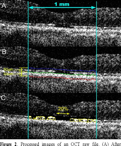 Figure 2 From Evaluation Of Correlation Between OCT Findings And Delayed Visual Acuity