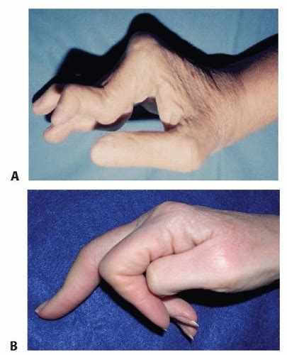 Proximal Interphalangeal And Metacarpophalangeal Joint Surface Replacement Arthroplasty
