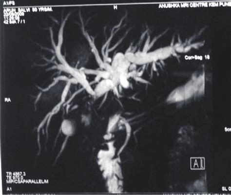 Magnetic Resonance Cholangiopancreatography Picture Download Scientific Diagram