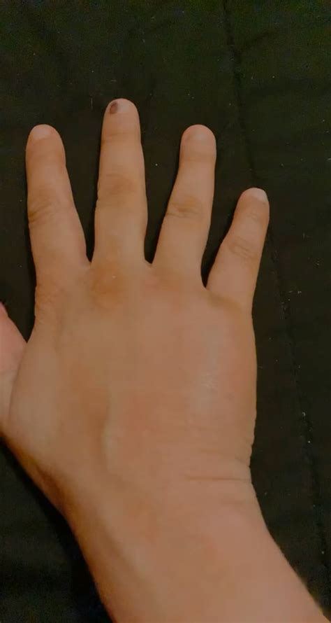 Boxers Fracture Broken 5th Metacarpal Was In Cast For 4 Weeks Seems To Be In The Hard Callus