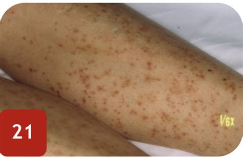 Insuffisance Veineuse Chronique Cartes Quizlet