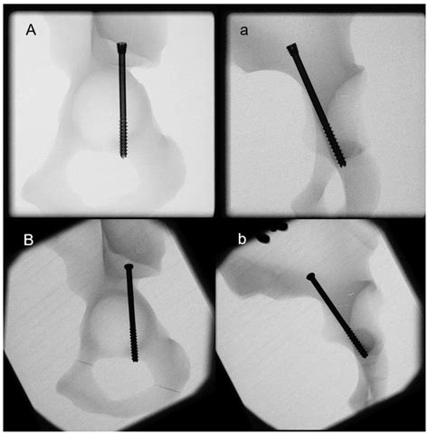 Medicina Free Full Text Antegrade Posterior Column Acetabulum Fracture Screw Fixation Via