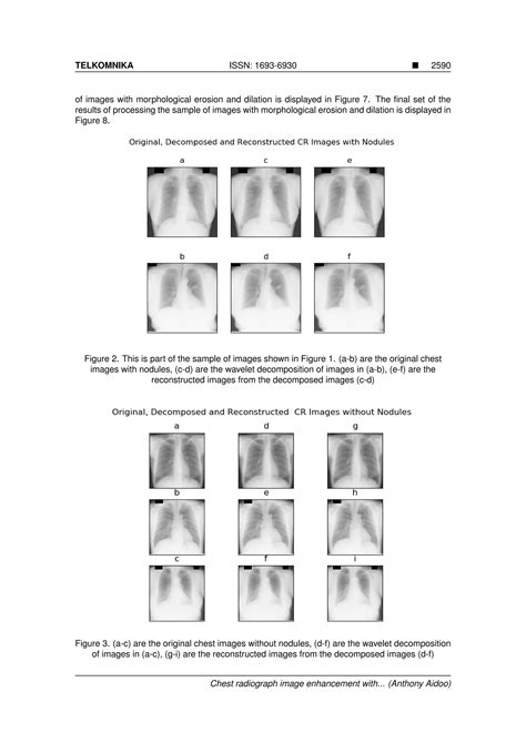 Chest Radiograph Image Enhancement With Wavelet Decomposition And Morphological Operations Pdf