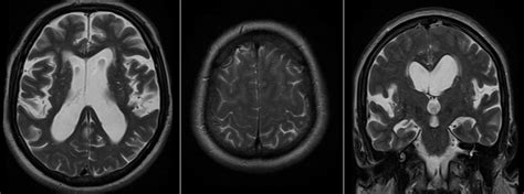 Mri Of The Brain Of The Patient With Inph The Enlarged Ventricles Of Download Scientific