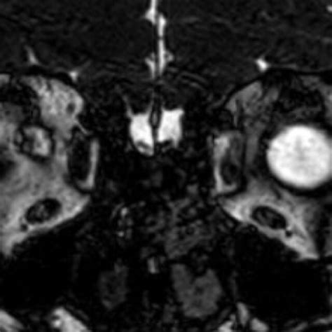 Coronal T2 Mri Demonstrates Olfactory Bulb Of Male Pt 40 Ys Old Shows