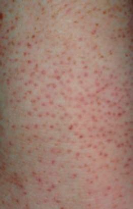 Skin Crash Course Day 8 Flashcards Quizlet