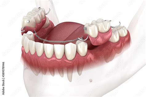 Mandibular Partial Denture