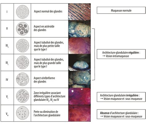 Comment Caractériser Les Polypes Colorectaux Et Quelles Classifications