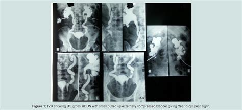 Figure From Pelvic And Abdominal Lipomatosis A Rare Case Report With Atypical Presentations