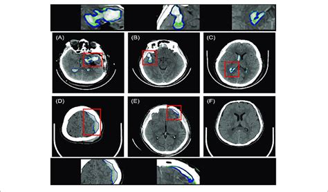 Intracranial Hemorrhage Segmentation Examples Of The Dense U Net From Download Scientific