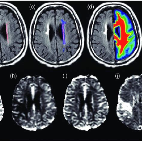 Neuroimaging Characteristics Of Diffuse Microvascular Dysfunction In A Download Scientific