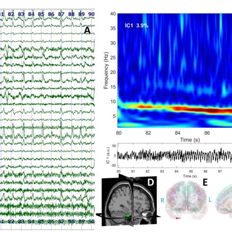 Figure E Eeg Data Displaying Rhythmic Ictal Discharge Over The Right