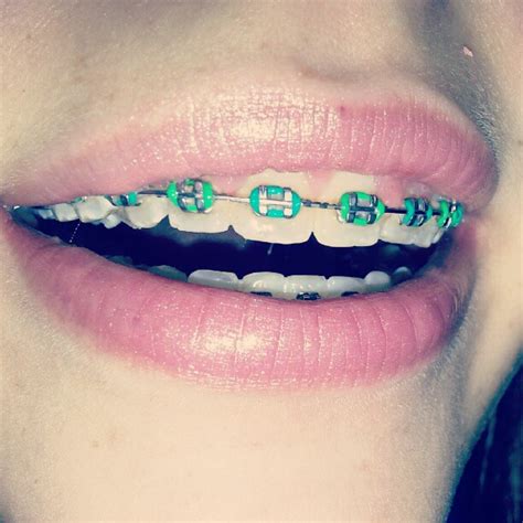 Smile With Braces Quotes QuotesGram
