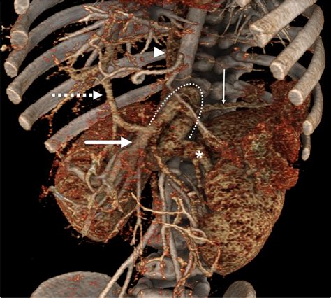 Oblique Frontal Volume Rendered Cta Showing The Extrahepatic Download Scientific Diagram