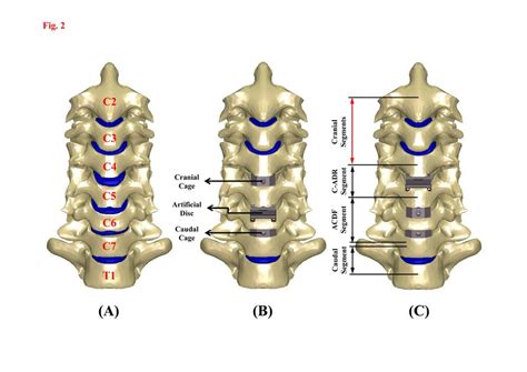 Three Finite Element Constructs Investigated In This Study A Intact Download Scientific Three Finite Element Constructs Investigated In This Study A Intact Download Scientific