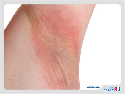 عرق سوز شدن چرا اتفاق می‌افتد؟ 5 دلیل مهم شیوه‌های درمان