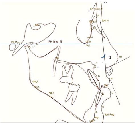 Soft Tissue Angular Measurements 1 Anb Of Soft Tissue And 2