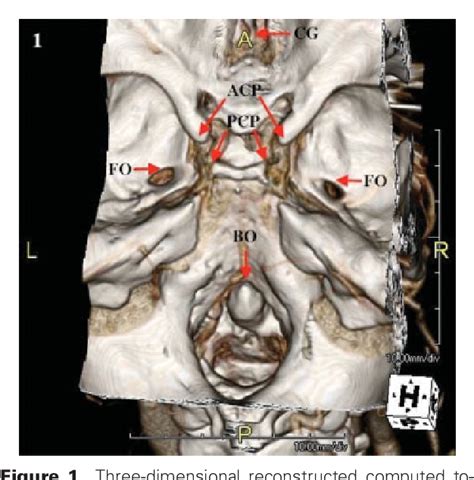 Structure Of Posterior Clinoid Process Semantic Scholar