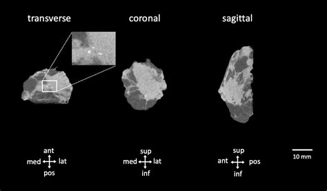 Imaging Case 4 Breast Invasive Ductal Carcinoma International
