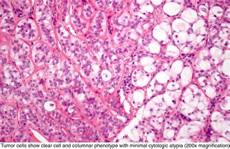 Pathology Outlines Clear Cell Carcinoma