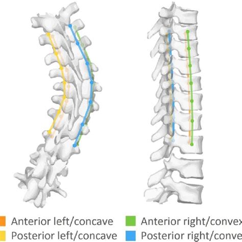 Schematic Figure From A Posterior And Right Side View Of A Right Convex