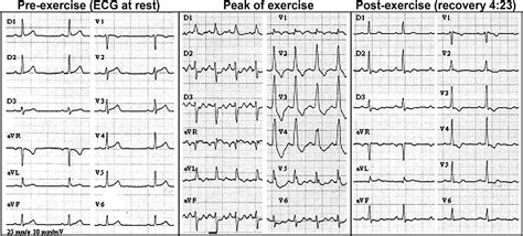 Left Septal Fascicular Block Evidence Causes And Diagnostic Criteria Heart Rhythm