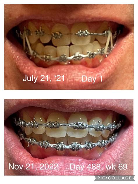 Those Who Got Only One Set Of Braces Initially Top Or Bottom How